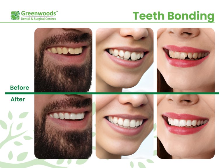 Tooth Bonding: Achieve a Beautiful Smile | Greenwoods Dental