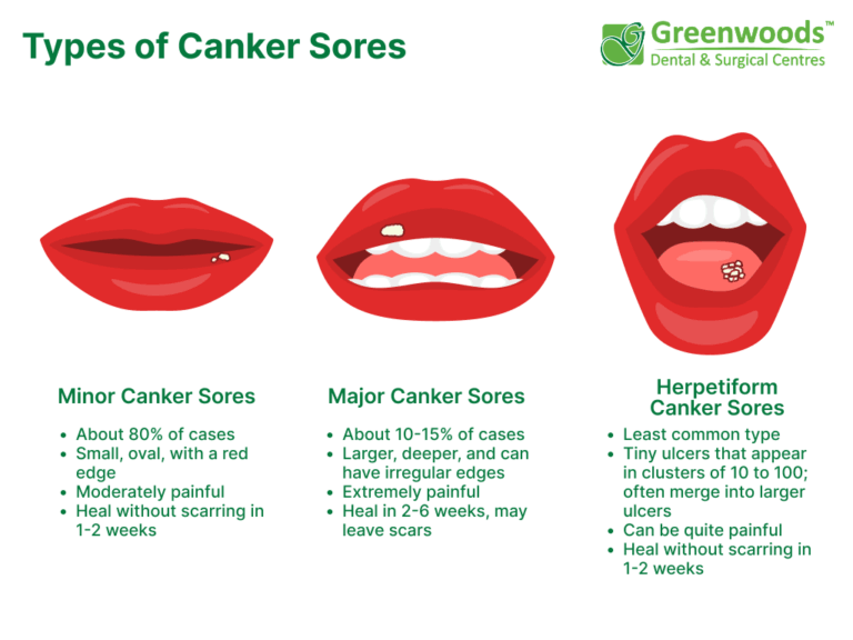 Canker Sore Treatment & Causes | Greenwoods Dental Blog