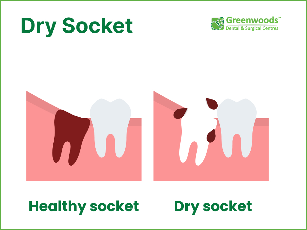 Dry Socket Explained: Proven Causes, Symptoms, and Faster Healing ...
